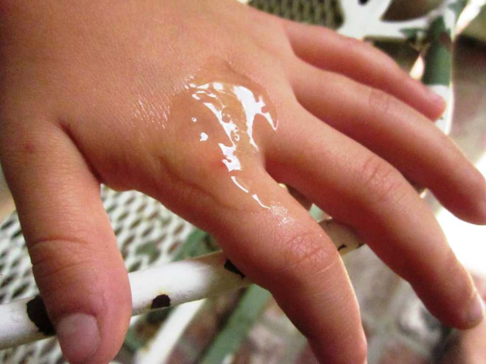 Splinter, Sliver, Stinger, Sticker & Cactus Needle Remedy Recipe - Food.com